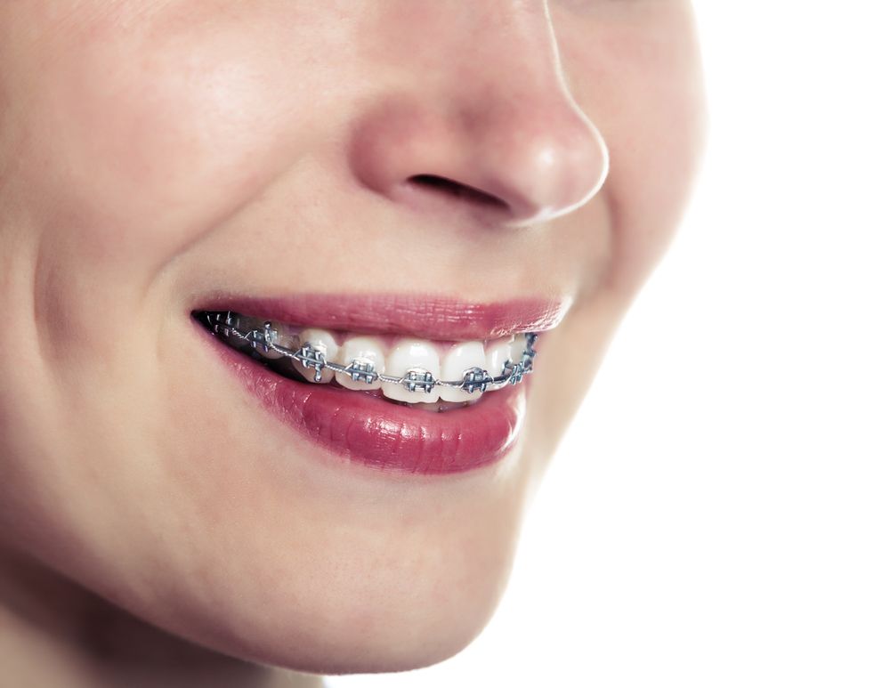 Types Of Braces Types Of Braces